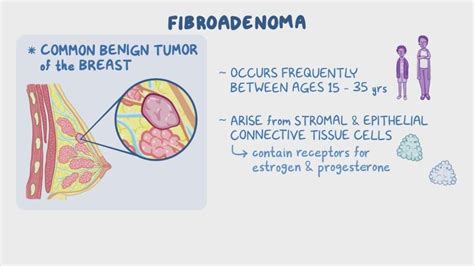 Victor Tsan On Linkedin Fibroid Homeopathic Treatment Fibroid Is A