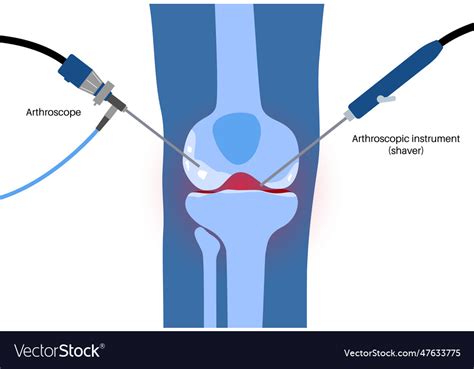 Knee Joint Arthroscopy Royalty Free Vector Image