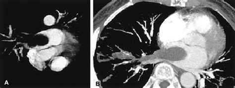A 3d Reconstruction Of The Chest Ct Show A Filling Defect In The Left