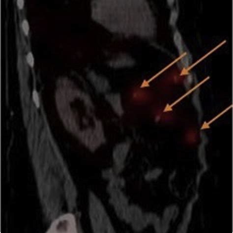 Abdominal Ct Scan Of A Splenic Nodule Before And After Contrast Medium Download Scientific
