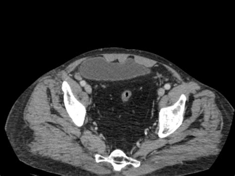 Pelvic Lipomatosis Pacs