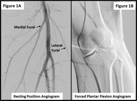 Dynamic Imaging Is The Ideal Modality For The Diagnosis Of Popliteal
