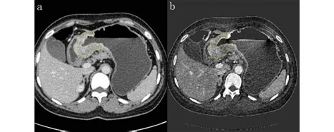 Tumor Segmentation Method Axial Venous Phase Mixed Images A