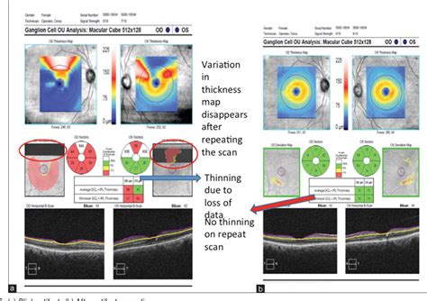 Figure From Interpretation Of Optical Coherence Tomography Semantic Scholar