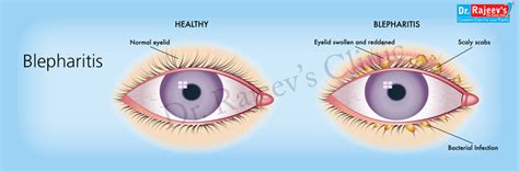 Squamous Blepharitis