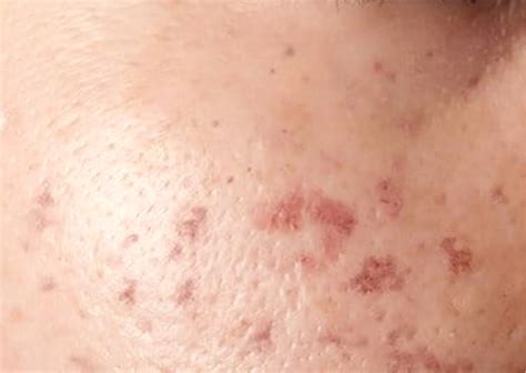 Effective Hyperpigmentation Treatment In KL Neya Malaysia