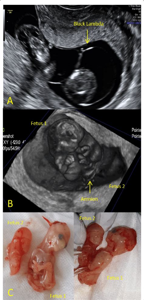Amnion Ultrasound