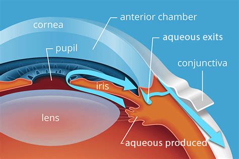 What Is Secondary Glaucoma