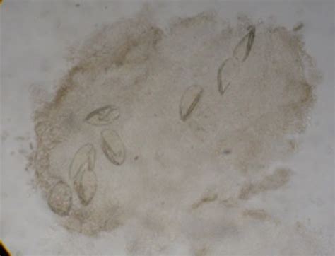 피부 파고들어 알 수십 개 낳는다 퇴치 운동 시작된 ‘이 진드기