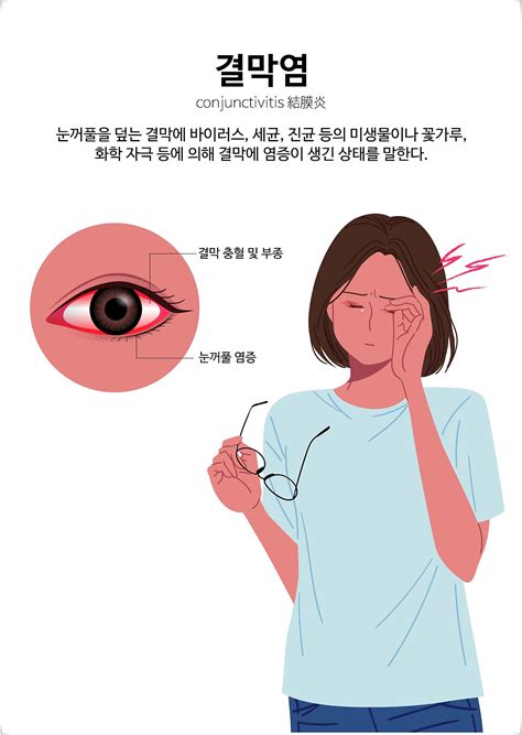 알레르기 결막염 치료 방법 알아보기 네이버 포스트