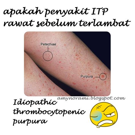 Suami Nazak Mengidap Penyakit Itp Idiopathic Thrombocytopenic Purpura
