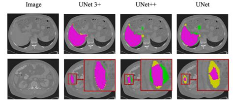 Unet 3 A Full Scale Connected Unet For Medical Image Segmentation