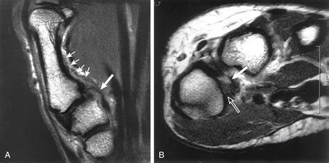 Intra Articular Injection Of The Carpometacarpal Joint Of The Thumb