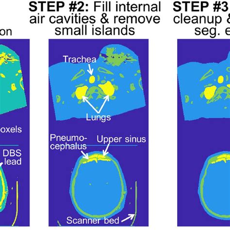 Segmentation And Meshing Pipeline For Creation Of The Initial Body