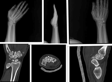 Right Hand Scaphoid View Right Hand Lateral Right Hand Ap Right Hand Download Scientific