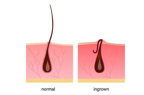 Does Epilation Cause Ingrown Hairs And How To Prevent It I Our 2023 Guide