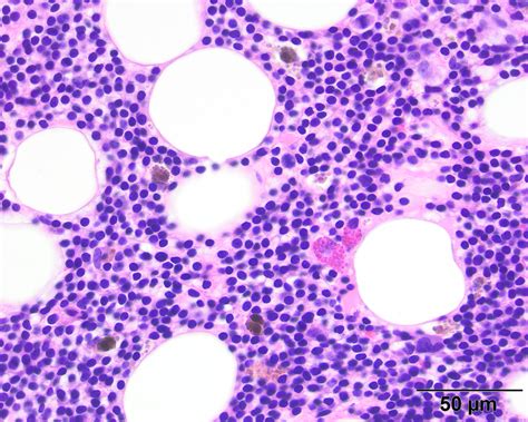 Figure 7 Bone Core Biopsy 50x Hande Stain Eclinpath