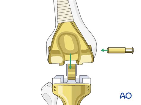 Proximal Tibia Replacement For Fracture Around A Loose Tibial Component With Poor Bone Stock