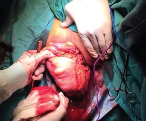Perineal Rectosigmoidectomy For Incarcerated Rectal Prolapse Altemeier