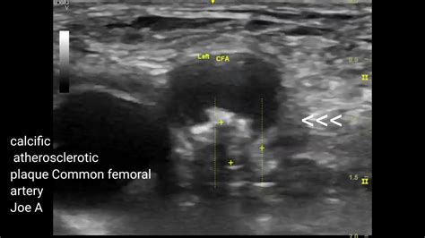 Calcific Atherosclerotic Plaque Common Femoral Artery Color Doppler
