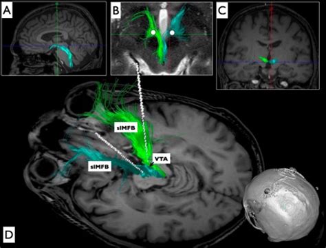 Dr Zohreh Majd On Linkedin Deep Brain Stimulation Of The Medial Forebrain Bundle” A Strategy