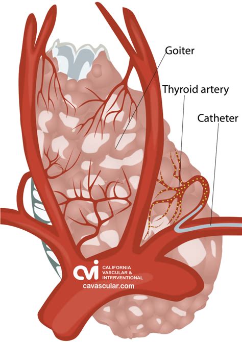 Thyroid Goiter Embolization Treatment Cvi Thyroid Center