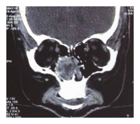 Computed Tomography Coronal A And Axial B Planes Demonstrate
