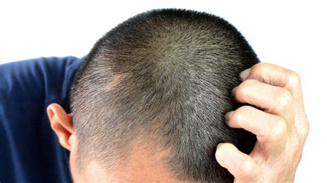 Pictures Of Sores And Scabs On Scalp Causes And More