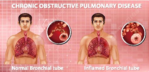 Chronic Obstructive Pulmonary Disease Info Comparison Healthy Vector