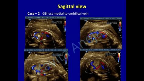 Umbilical Portal Venous System And Persistent Right Umbilical Vein