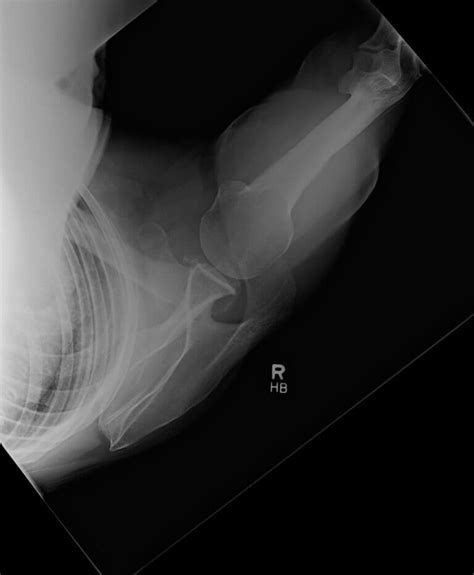 Orthodx Glenoid Fracture Clinical Advisor