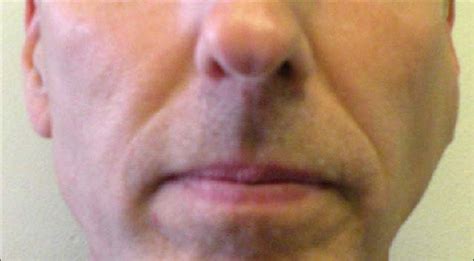 Parotid Gland Swollen One Side