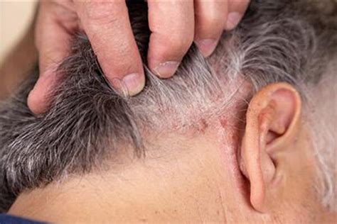 Non Segmental Vs Segmental Vitiligo Which One Do You Have