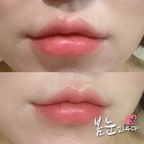봄눈피우다의원 입술은 리터치를 통해 완성됩니다😘 ⠀ 저희 봄눈의 모든 입술필러 시술은 기본 2회