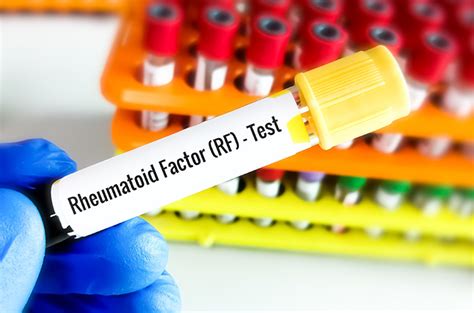 Cek Rheumatoid Factor Rf Pengertian Manfaat Dan Prosedur Halodoc