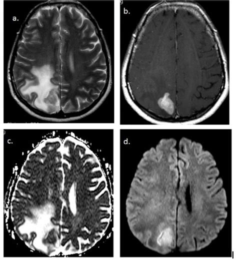 T2 Images Hypointense Lesion Dwi Restricted Water Diffusion T1