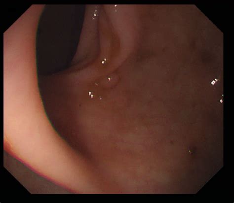 Polyp Detection In Colonoscopy Images Object Detection Dataset And Pre