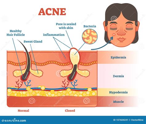 Acne Diagram Illustration With Hair Pimple Skin Layers And Structure