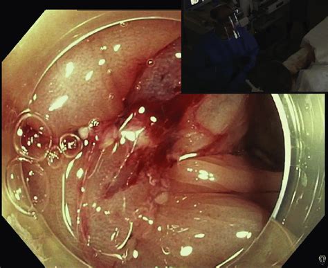 Mucosal Defect After Lesion Removal Is Completely Closed With 1