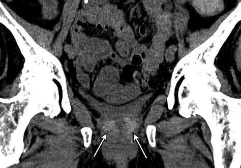 Injection Of Silicone Particles Macroplastique As A Urethral Bulking