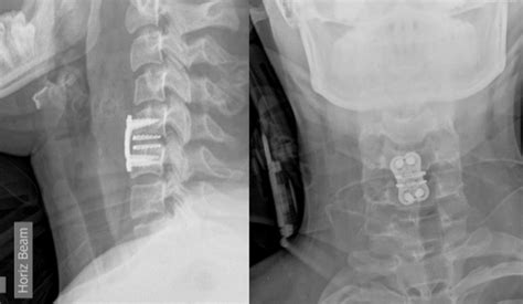Flexion Teardrop Fracture