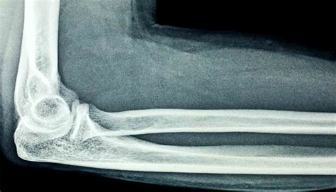 Whats The Sex Of That Skeleton Check The Elbow Futurity