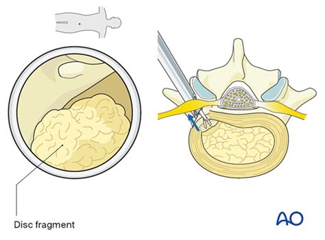 Extraforaminal Endoscopic Lumbar Discectomy Eeld For Lumbar Disc