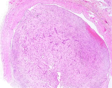 Innovative Science Press On Twitter Such A Nice Example Of Intravascular Fasciitis The