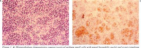 Figure 1 From Olfactory Neuroblastoma A Case Report And Review Of The Literature Semantic Scholar