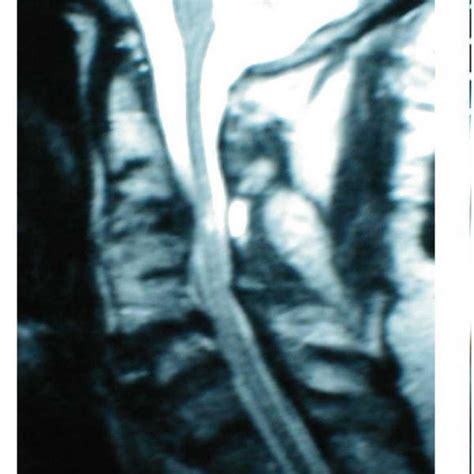 Lateral View Of Cervical Spine Shows Congenital Fusion Of Bodies Of C2