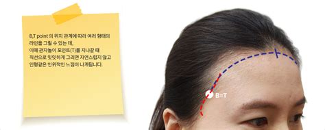 루트모발이식 3d헤어라인 디자인