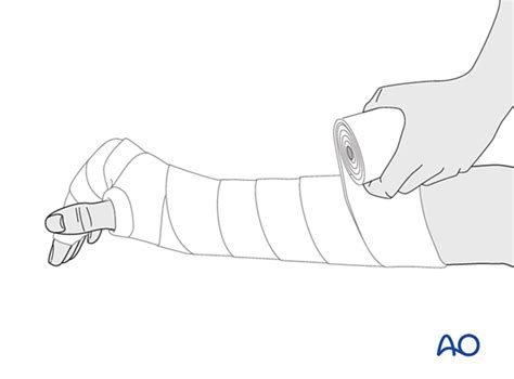 Closed Reduction Splinting For Extraarticular Fracture Of The Proximal End Segment