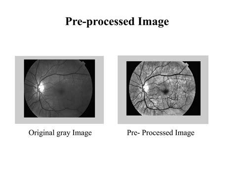 Diabetic Retinopathy Analysis Using Fundus Image Pptx