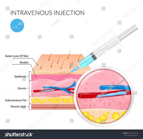 Intravenous Injection